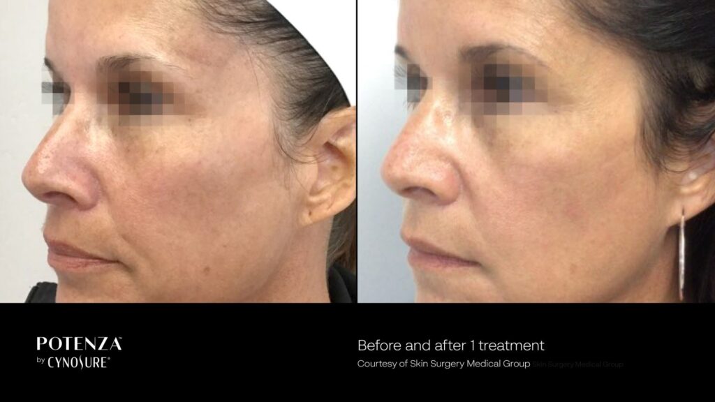 Potenza RF Microneedling Rancho Cucamonga | Redlands | Hesperia